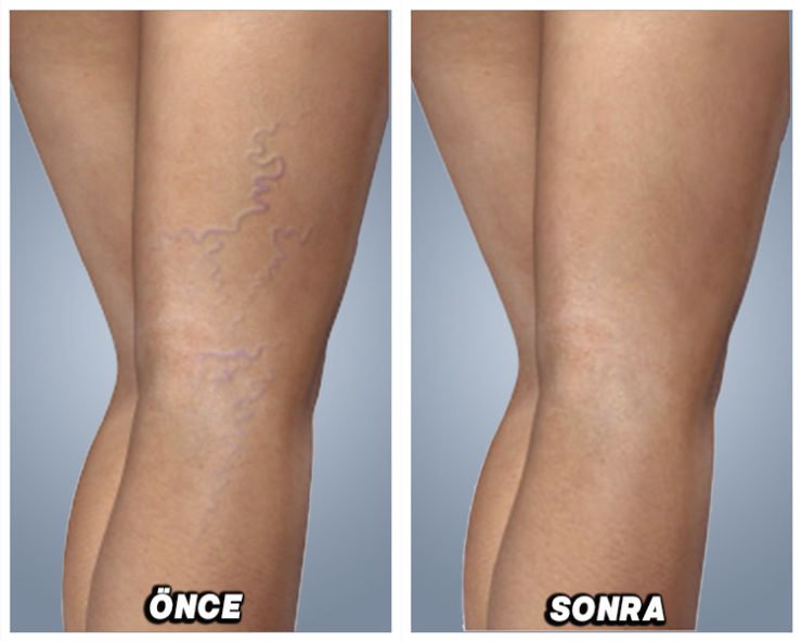 Duştan Sonra Bacaklarınızı Soğuk Suyla Yıkarsanız - Bilgecafe